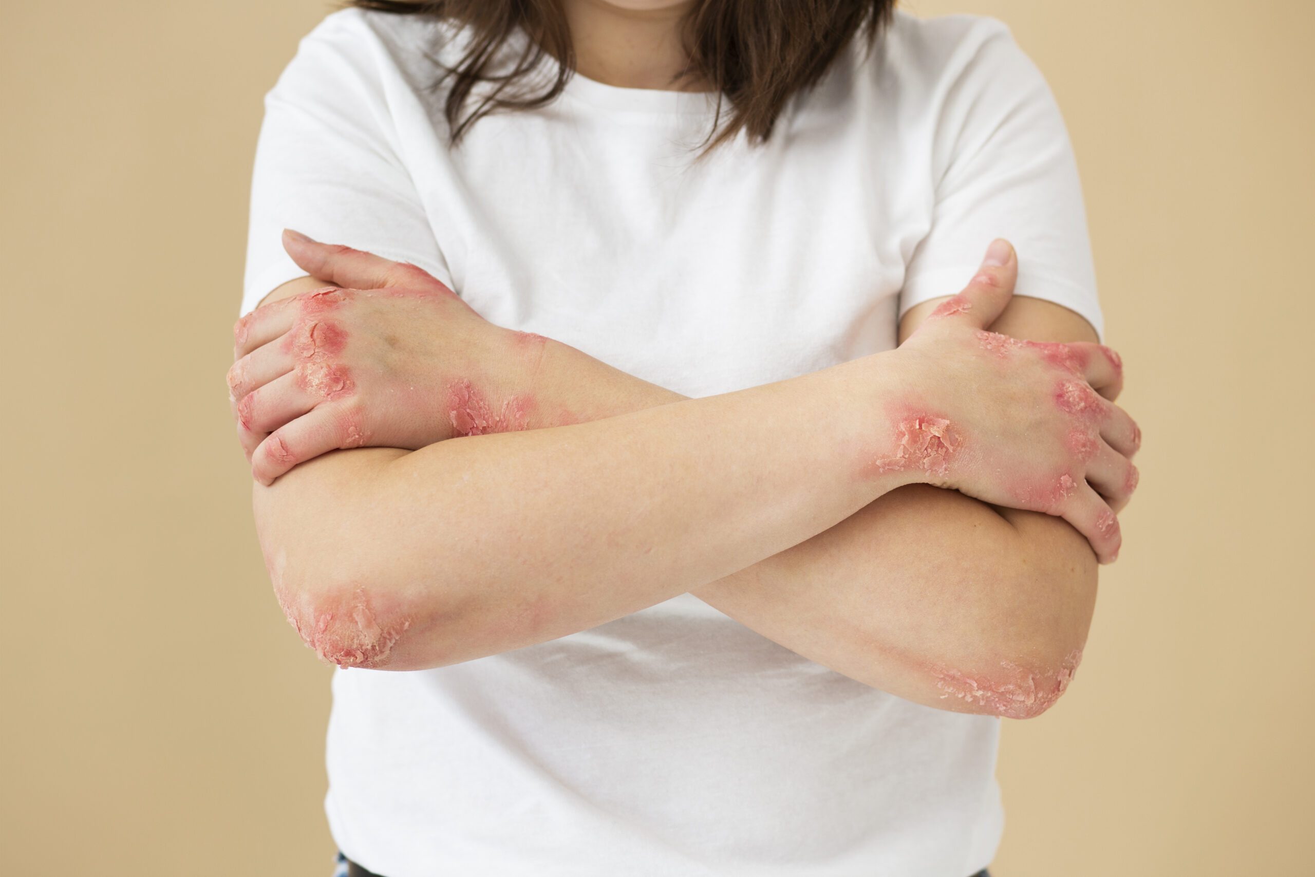 Skin diseases:Psoriasis - IHMO